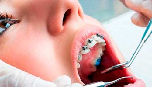 ¿Duele la colocación de brackets?